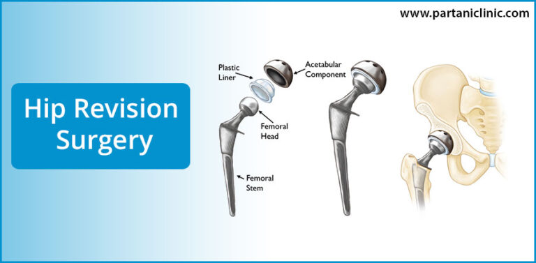 Hip Revision Surgery in Jaipur by Dr. Arun | Partani Clinic