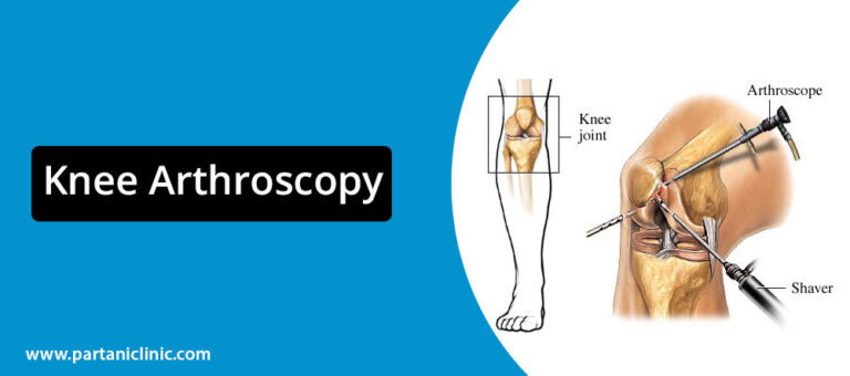 Knee Arthroscopy in Jaipur | Arthoscopic Surgeon | Dr. Arun Partani