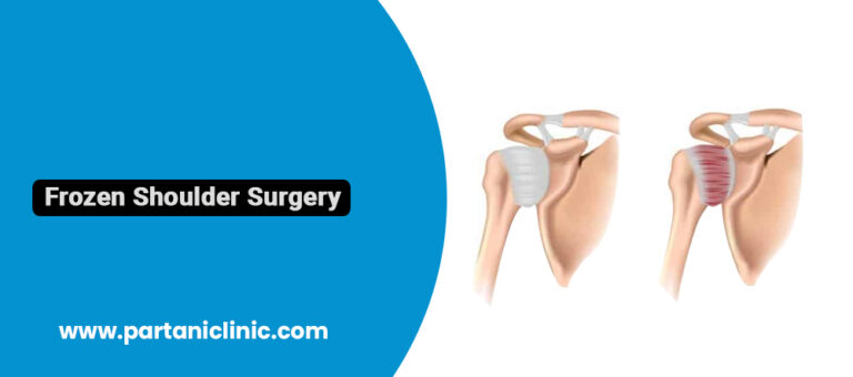 Frozen Shoulder Treatment in Jaipur by Dr. Arun Partani | Shoulder Doctor