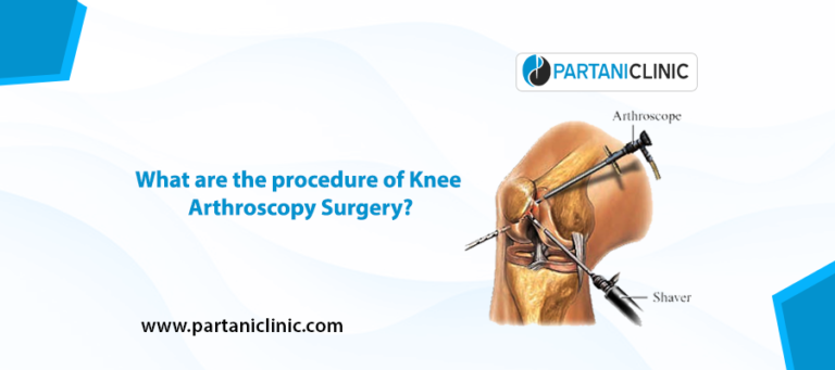 What is the procedure of Knee Arthroscopy Surgery? | Dr. Arun Partani