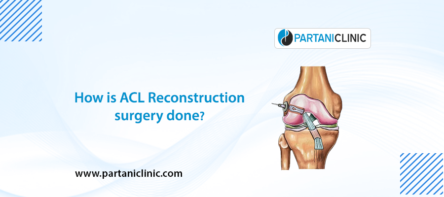 How is ACL Reconstruction Surgery done? | Dr. Arun Partani