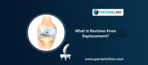 What is Revision Knee Replacement? | Partani Clinic
