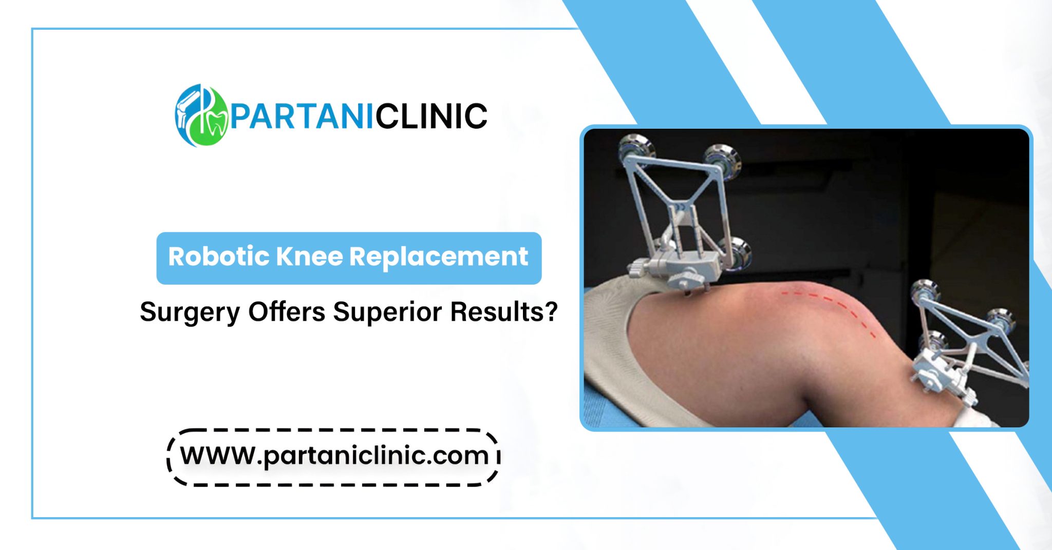 Why Robotic Knee Replacement Surgery Offers Superior Results | Partani ...